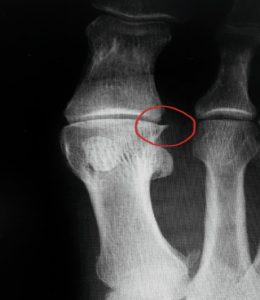 Alluce Rigido - Massimo Drommi